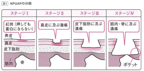 褥瘡治療の外用薬とドレッシング材（創傷被覆材） Dr クルクルの徒然日誌