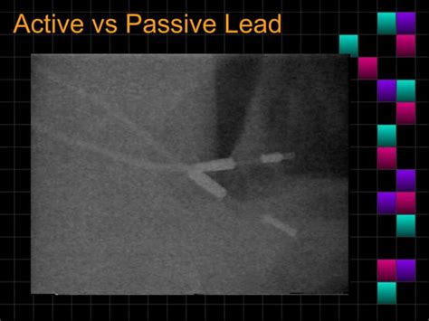 Pacemaker Radiologyanintroduction Ppt