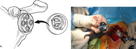 Glenoid Component Clinical Tree