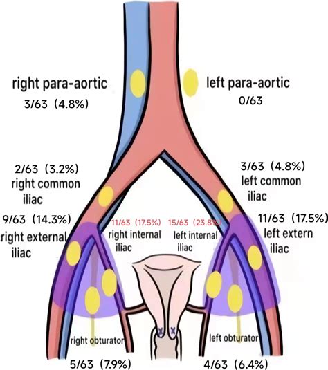 Distribution Pattern Of Pelvic And Abdominal Sentinel Lymph Nodes Download Scientific Diagram