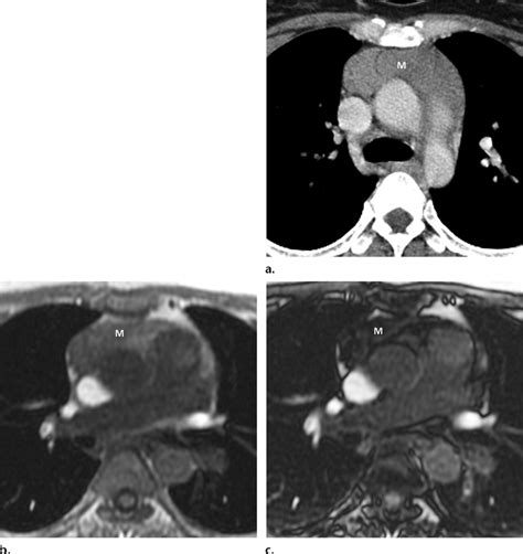 Thymic Biopsy At James Jain Blog