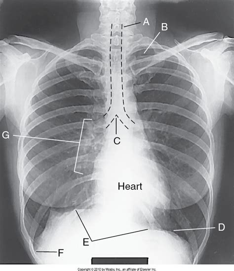 Ap Chest X Ray Diagram Quizlet