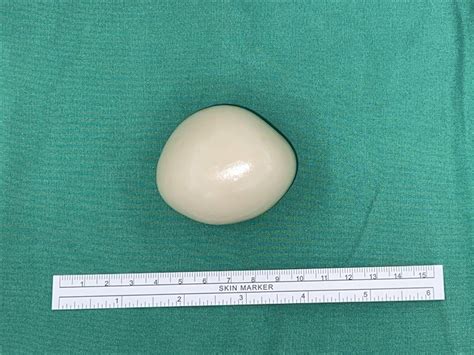 病人開刀取出「巨大舍利子」！醫師驚曝真相：消化外科最常遇到 祝你健康 三立新聞網 Healthsetncom