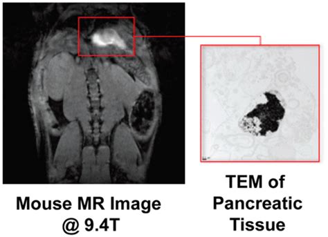 Reticulum Cell Sarcoma X Ray
