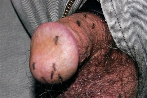 Insect Bite Torture Cumception