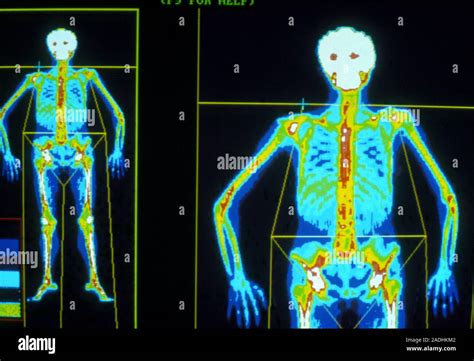Osteoporosis Coloured Bone Densitometry Scan Of A Patient Suffering