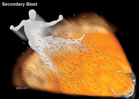 Blast Injuries From Improvised Explosive Device Blasts To The Boston