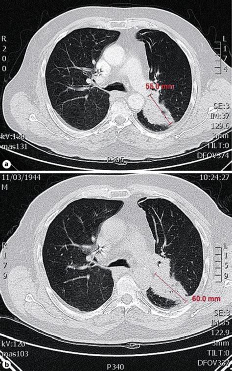 Octreotide Scan Imaging At Recurrence A And At The Time Of The Download Scientific Diagram