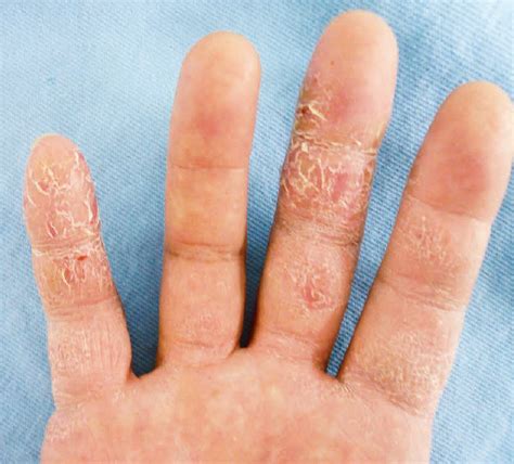 手湿疹[主婦湿疹]｜湿疹、皮膚炎③ 看護roo [カンゴルー]