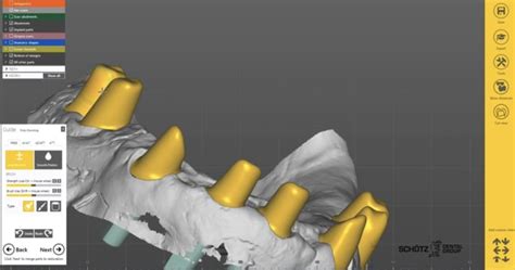 Design Your Dental Projects Using Exocad By Stoynoivanov Fiverr