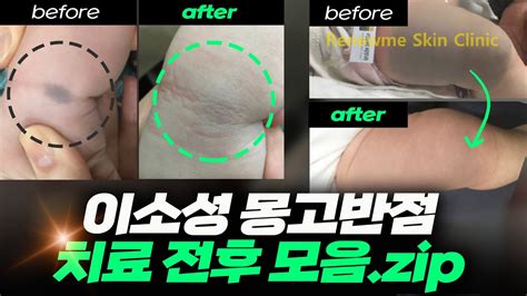 연약한 아기피부에 맞춘 치료법 이소성 몽고반점 제거 전후 비교 Youtube
