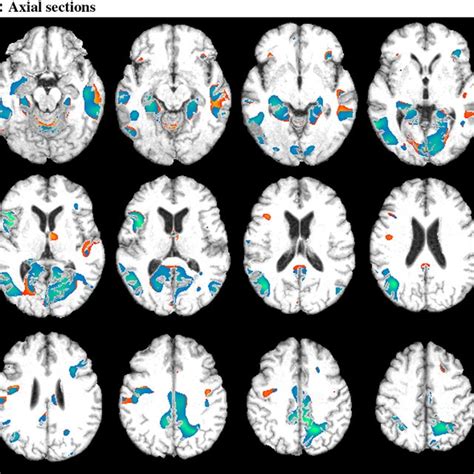 Joint Ica Of Fmri And Dti Data Component 6 Of 8 Demonstrated The Dmn