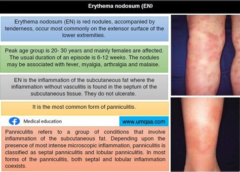 What Are The Causes Of Erythema Nodosum En Artofit