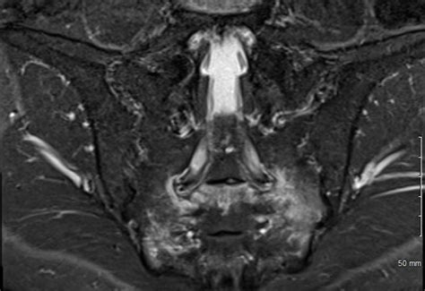 How To Identify And Manage Sacral Stress Fractures Sport Doctor London