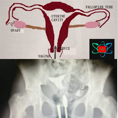 What To Expect At Hysterosalpingography Hsg Procedure Womens Health