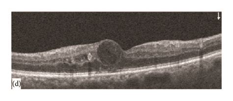 Structural OCT Of The Left Macula A At Presentation There Were Download Scientific Diagram
