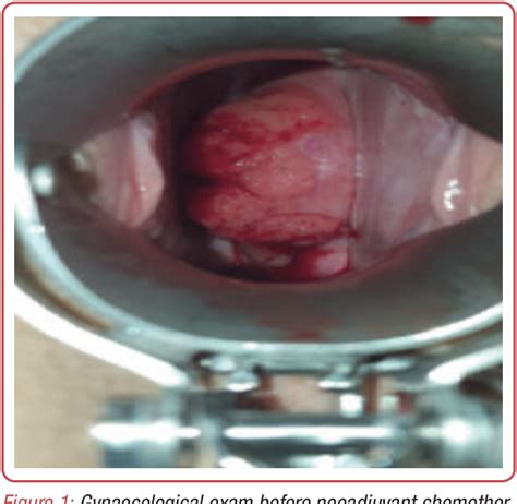 Figure 1 From Simple Trachelectomy Following Neoadjuvant Chemotherapy In Cervical Cancer Over 2