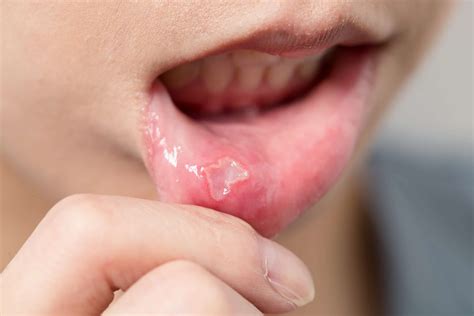 Canker Sores On Tongue