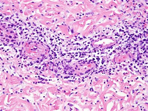 Perniosis Dermatopathology