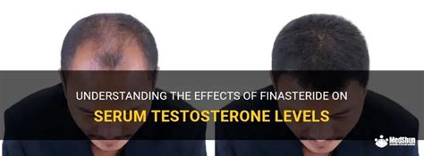Understanding The Effects Of Finasteride On Serum Testosterone Levels Medshun
