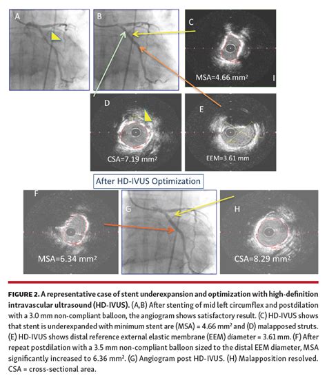 A New Method To Optimize Stent Deployment By High Definition Intravascular Ultrasound