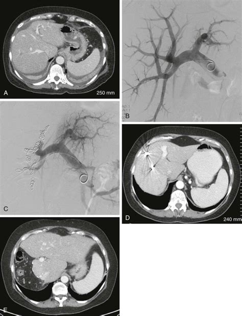 Interventional Radiology Of The Liver Radiology Key