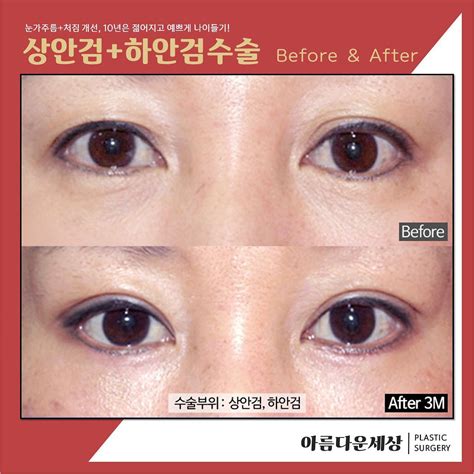 아름다운세상성형외과 자연스럽게 처진 눈가주름 개선으로 10년이상 젊어보이게 예쁘게 나이들기 😉