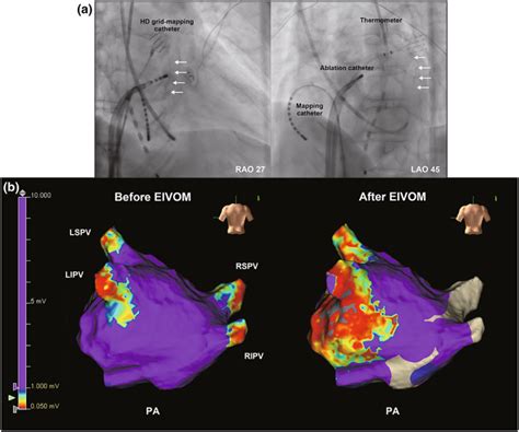 Roof‐dependent Atrial Flutter With Epicardial Conduction Pathway Masked By Left Atrium Posterior