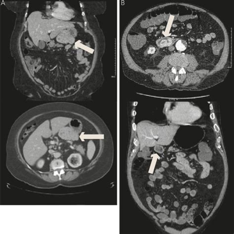 A Resectable Gastric Gist On Computed Tomography Ct Scan B Download Scientific Diagram
