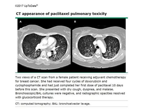 Taxane Management Of Side Effects Ppt