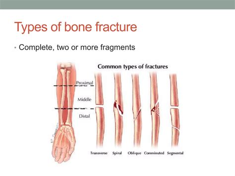 Introduction To Bone Fracture Pptx