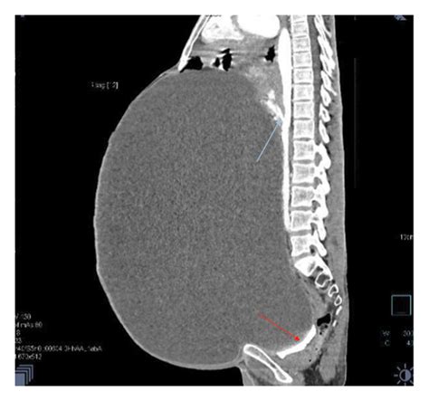 Giant Mesenteric Cyst In A Young Adult Mimicking Refractory Ascites A