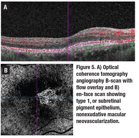 AMD Consensus Nomenclature Explained OFF