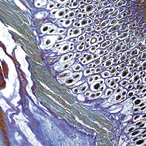 Miocarditis Bacteriana Enfermedad Cardíaca Inflamatoria