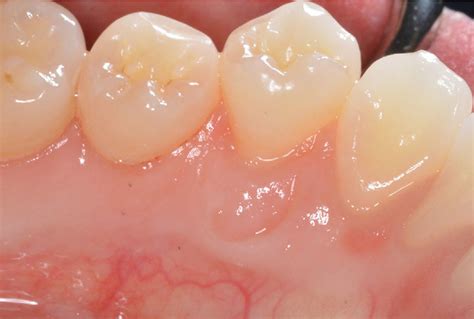 Twenty Four Months Follow Up Showing Stable Root Coverage And Download Scientific Diagram