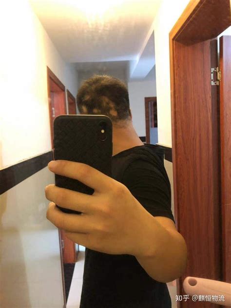 怎么还能治疗斑秃,大哥大姐给帮帮忙 知乎 怎么还能治疗斑秃,大哥大姐给帮帮忙 知乎