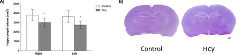 Dorsal Hippocampus Volume Assessment Right And Left Hippocamal Volumes