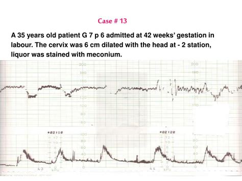 Ppt Intrapartum Ctg Workshop Powerpoint Presentation Free Download Id 6659508