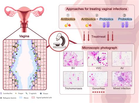 Vaginal Bacterial Infection Sores