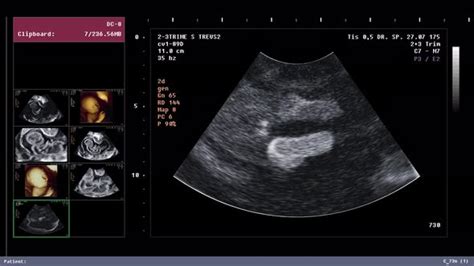 Diagnostic Ultrasound Screening Of Body During Pregnancy Determines Sex