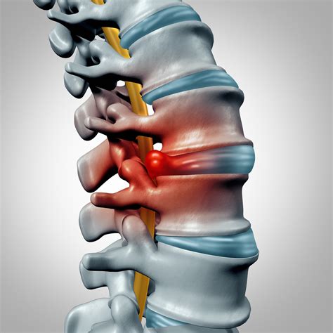 Herniated Disk Foundation For Orthopaedic Research And Education Fore