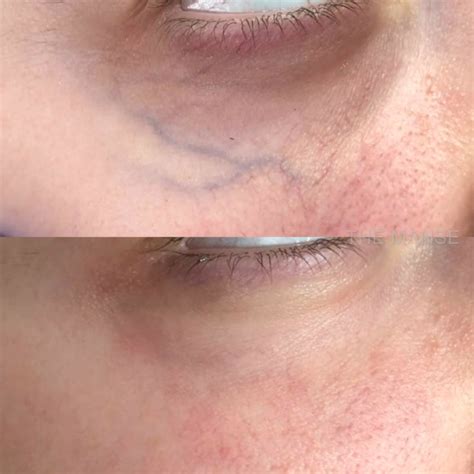 Blue Vein Removal Best Clinic For Facial Vein Removal Sydney