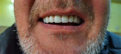 Зъботехник Благоевград протези Медицински Санитарни услуги Благоевград Изработка на п