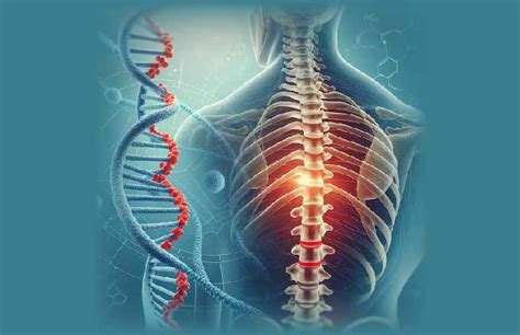 Vdr Gene Mutation And Scoliosis Bone Growth Treating Scoliosis