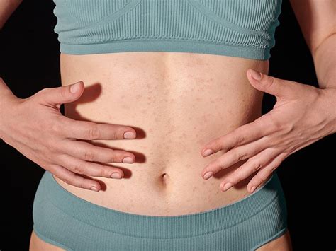 Pcos And Eczema Whats The Connection
