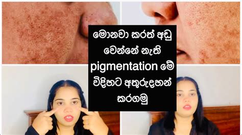 පිග්මන්ටේෂන් මෙලෙස්මා හෙවත් කලු ලප කැළැල් වලට හොදින් නැත්තම් නරකිමන් විසදුමක් Youtube