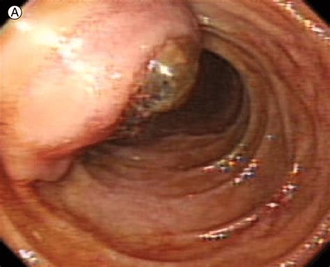 Endoscopic Findings A A Large Polypoid Mass With Central Ulceration