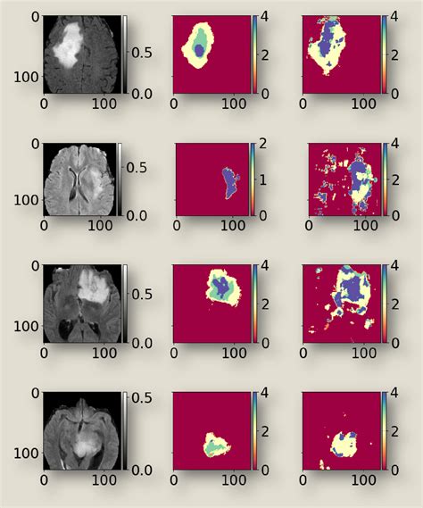 Figure 14 From Automatic Brain Tumor Detection And Classification On