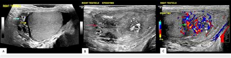 Epididymitis Ultrasound Emergency Ultrasound