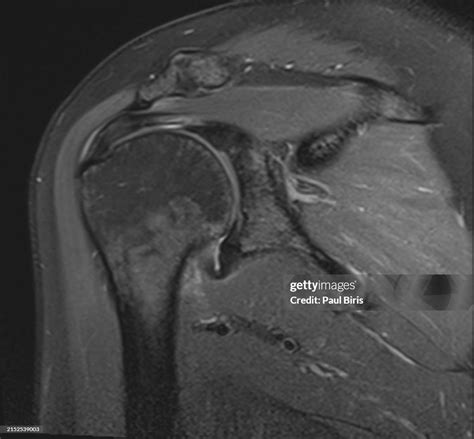 Mri Findings Of Acromioclavicular Joint Osteoarthritis
